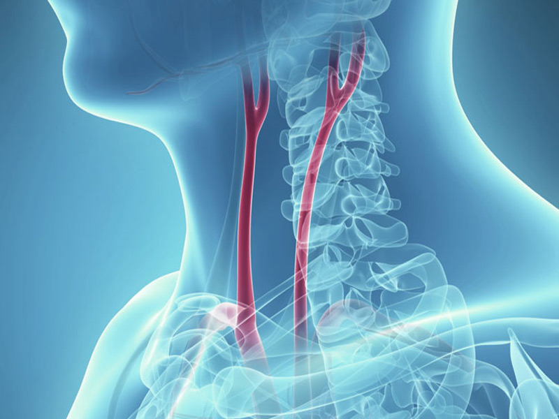 What Is Carotid Artery Disease & How to Prevent it?